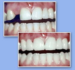 Zubné mostíky :: ZUBY